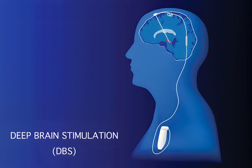 Deep Brain Stimulation Benefits You Should Know