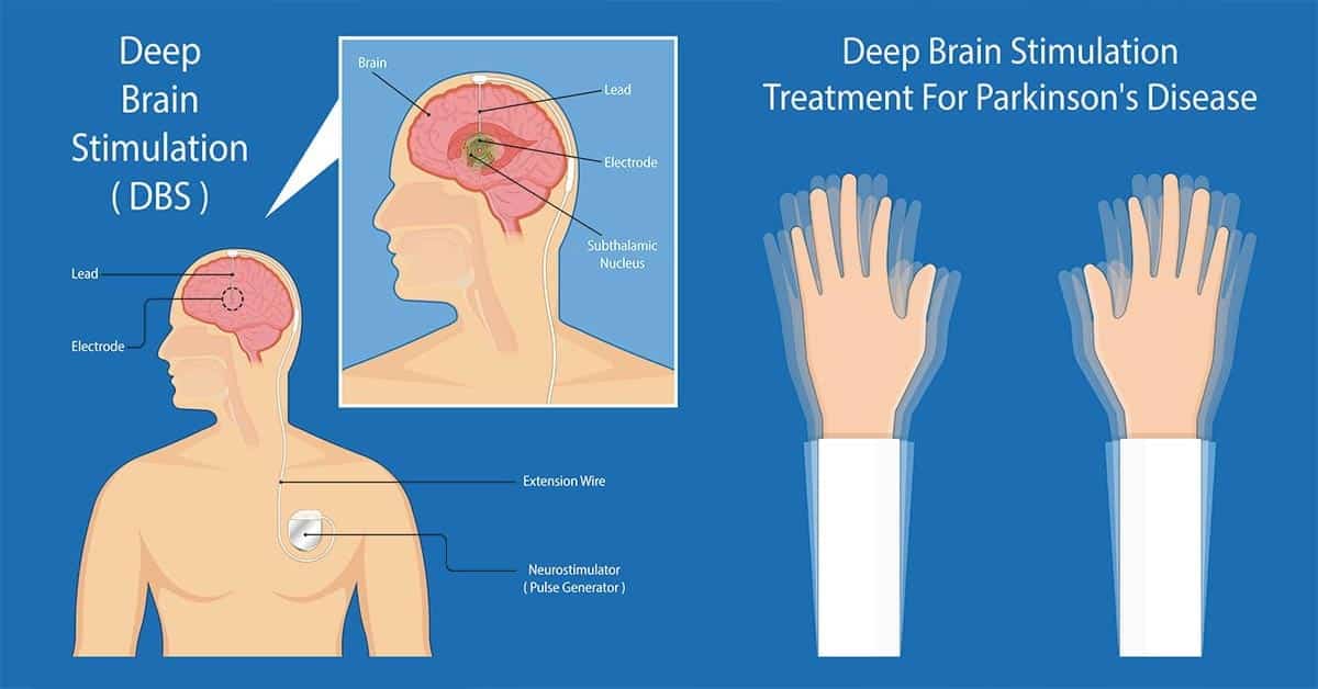 Deep Brain Stimulation in Mission Viejo, CA | Dr. Alex Taghva