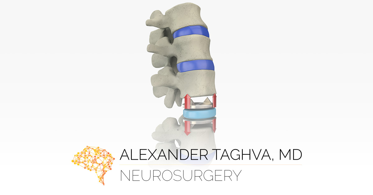Lumbar Artificial Disc Replacement in Mission Viejo, CA