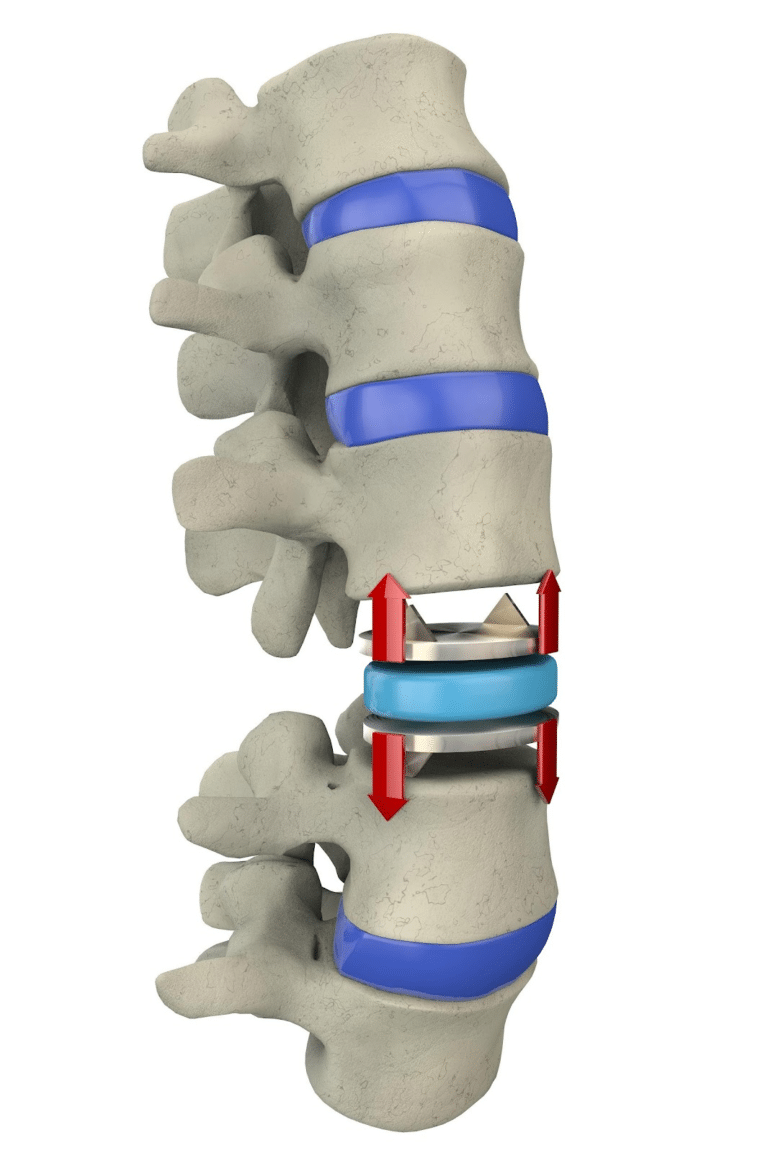Lumbar Artificial Disc Replacement | Orange County, CA